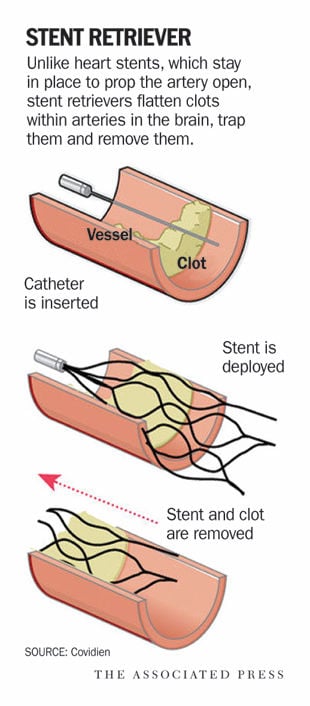 The stent retriever is being called a game changer in large-vessel stroke treatment | Live Well ...