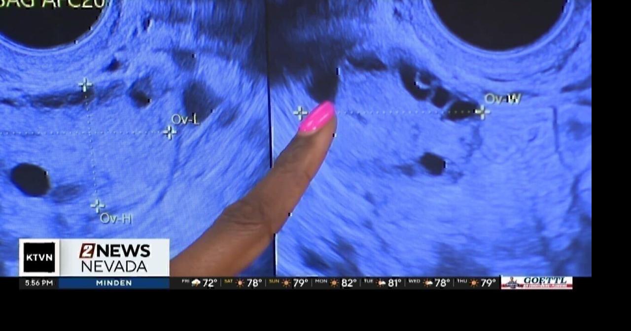 Health Watch: Raising awareness of PCOS impacts | Videos | 2news.com