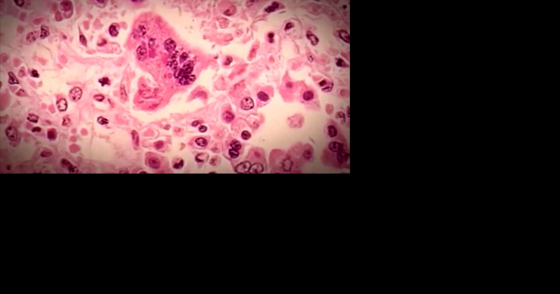 CDC in Texas, investigating nearly 160 cases of measles | Videos ...
