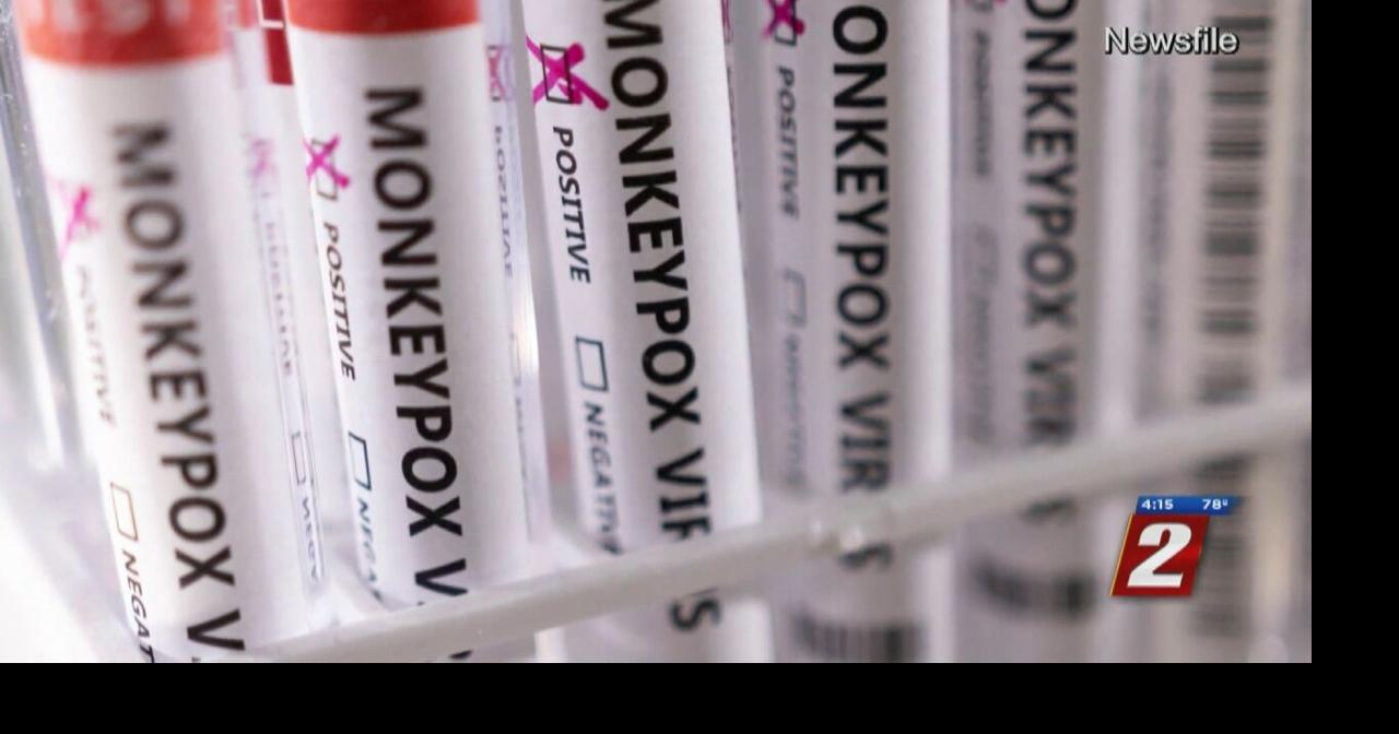 California Confirms Monkeypox Case Out Of Sacramento | News | 2news.com