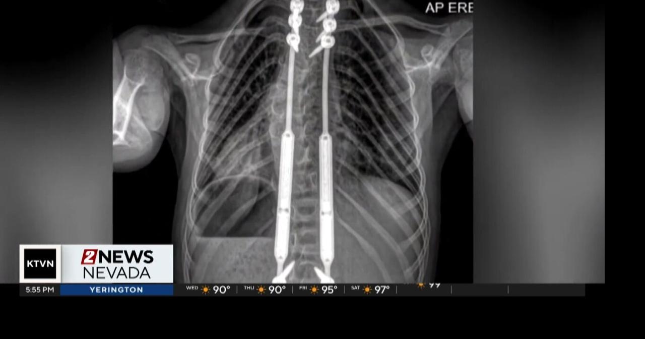 Health Watch: Scoliosis and "Magic Rods" | Videos | 2news.com