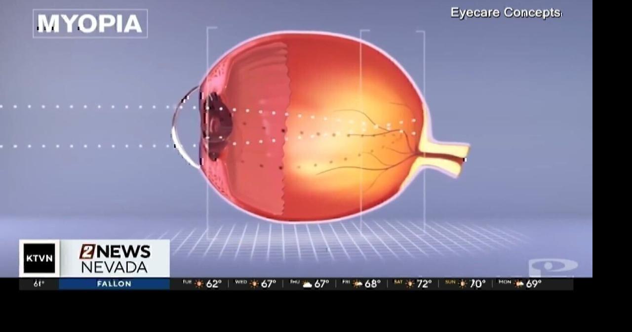 Health Watch: Myopia management for children | Videos | 2news.com