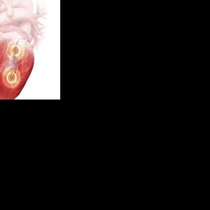 Overlake First to Offer Newest Pacemaker Technology | Wellness ...