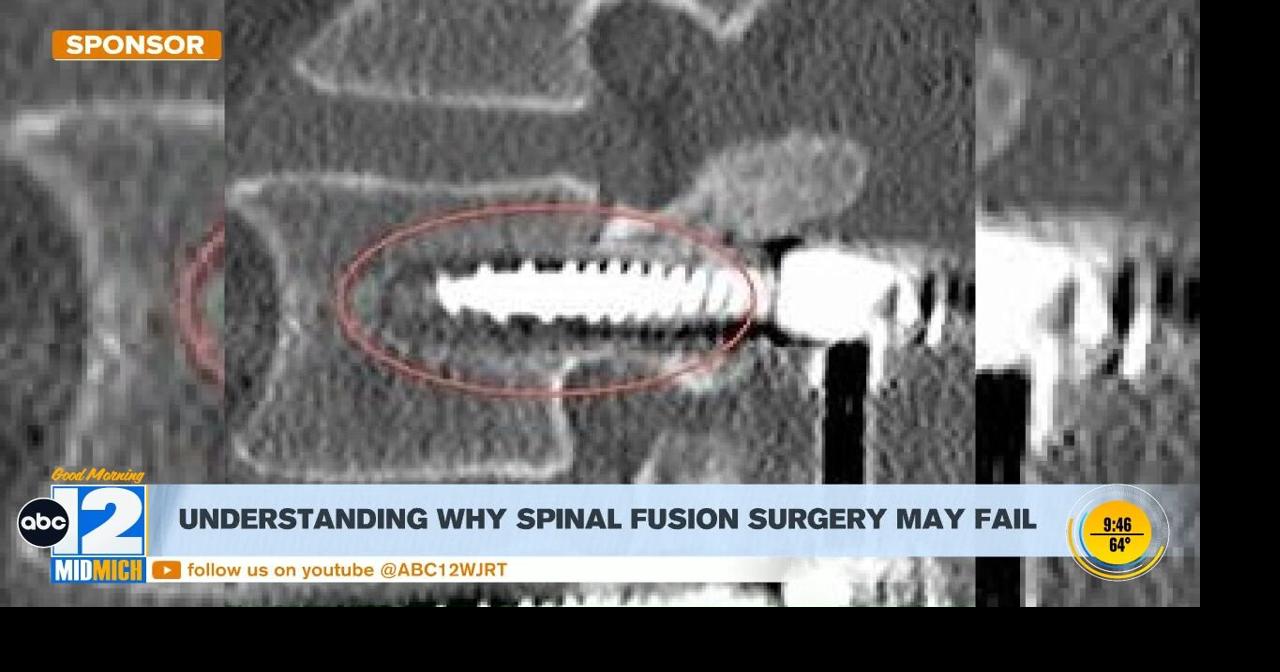 Understanding why spinal fusion surgery may fail | Video | abc12.com