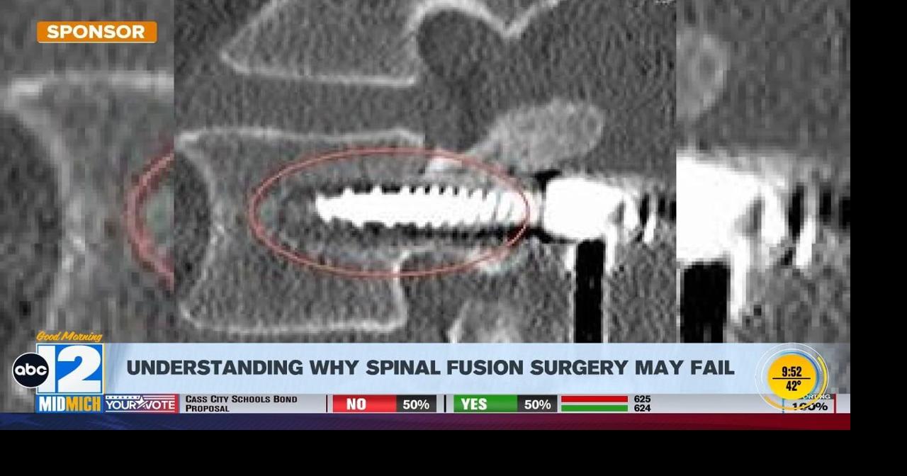 Understanding why spinal fusion surgery may fail | Video | abc12.com