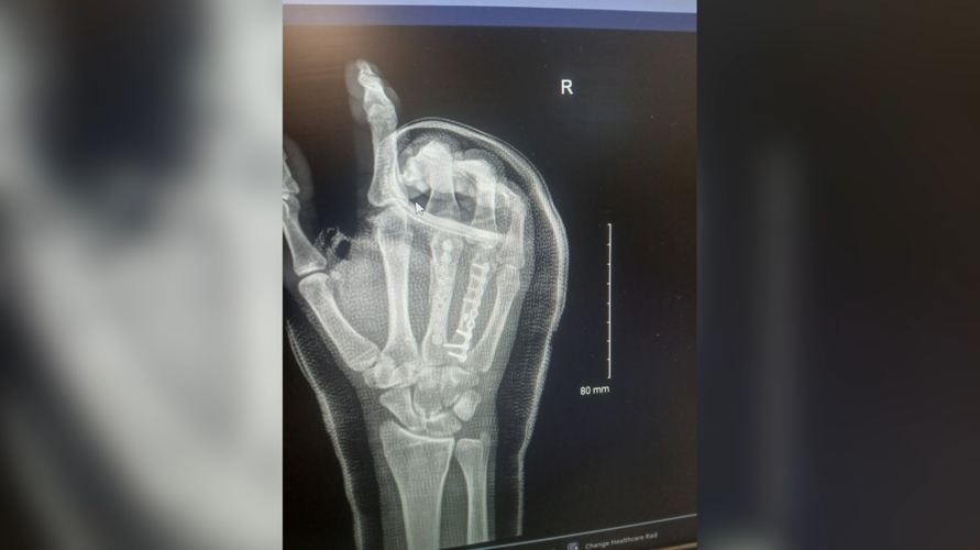Chico man recovering after hit & run crash while riding bicycle | News ...