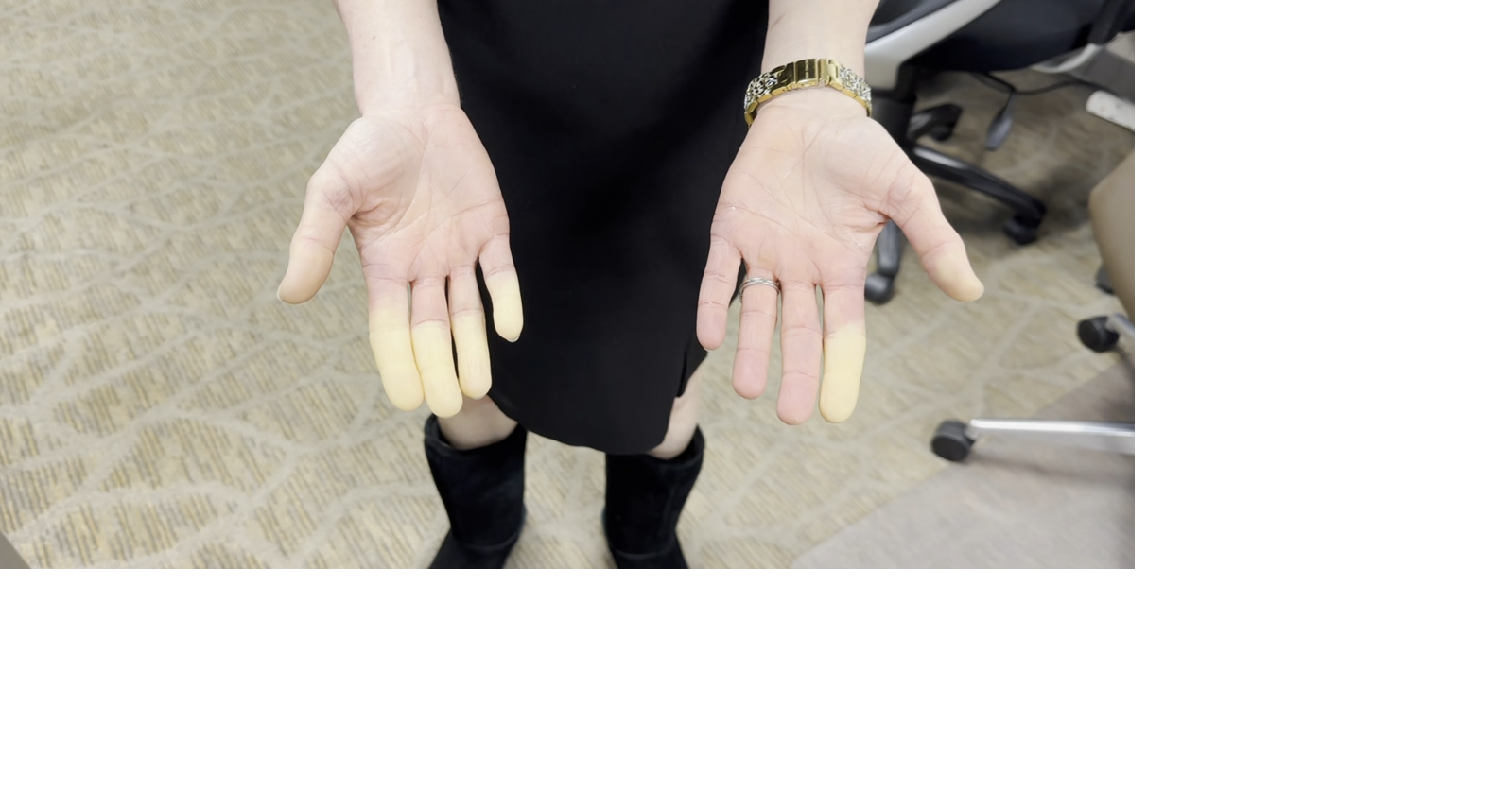 Managing Raynaud’s Syndrome: What to do when fingers turn white ...