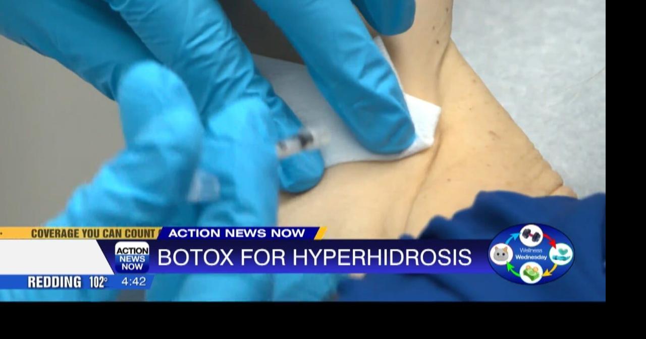 Botox for sweating? Chico doctor shares FDA-approved treatment ...