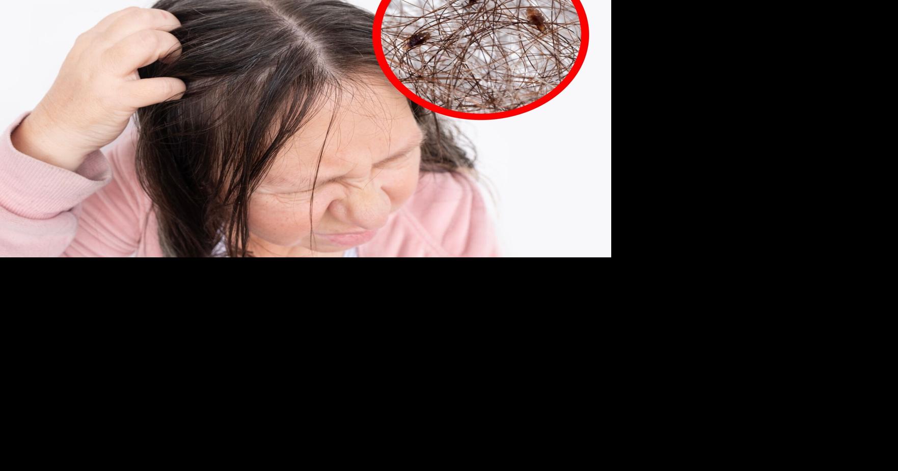 Don’t lose your head over lice | Local News | advantagenews.com