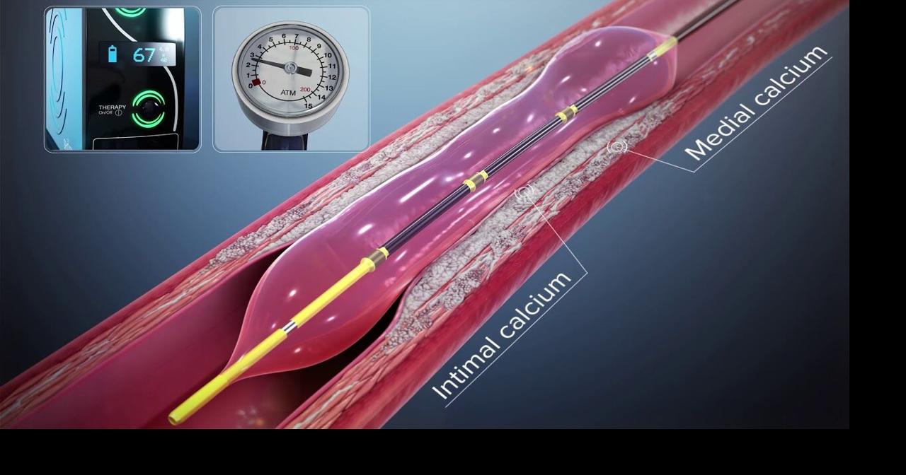 Groundbreaking "Shockwave" treatment gives new hope to North Oaks ...