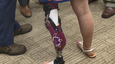 Backward leg allows young cancer survivor to dance | Health ...