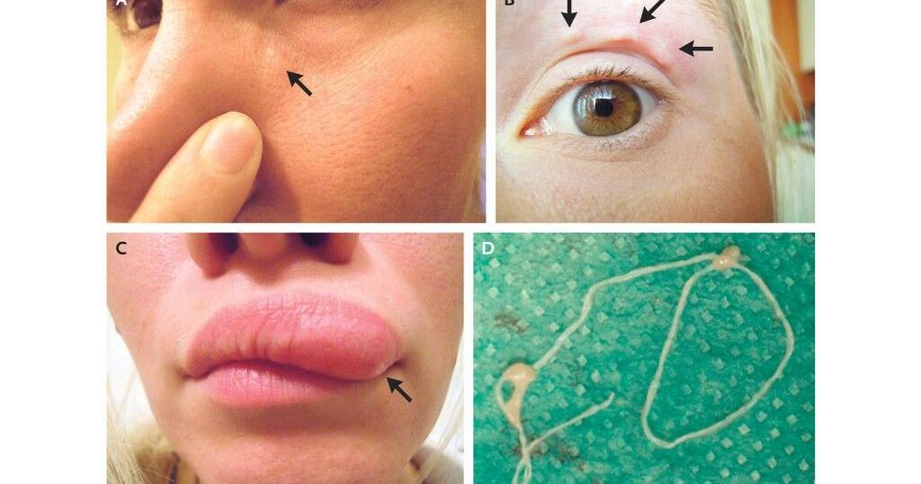 Moving lump on woman’s face turns out to be parasitic worm | Health ...