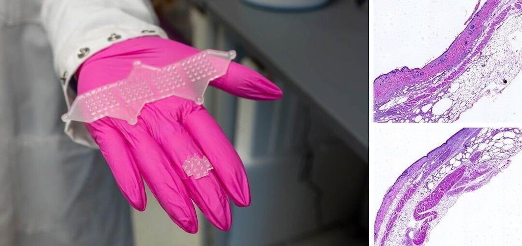 ‘Living bandage’ acelerates healing of wounds | Health | carrollspaper.com