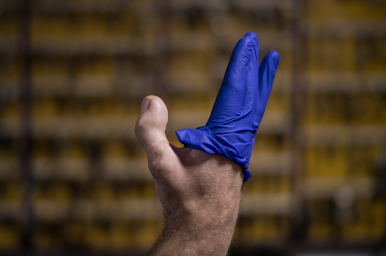 Cobbler who accidentally cut off thumb gets it replaced with his big ...