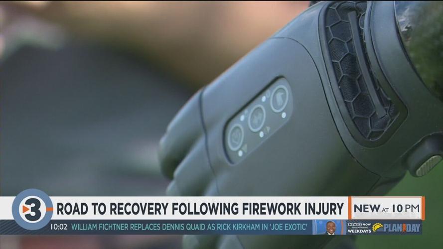 ‘My life changed forever’: Verona dad shares experience of losing hand ...