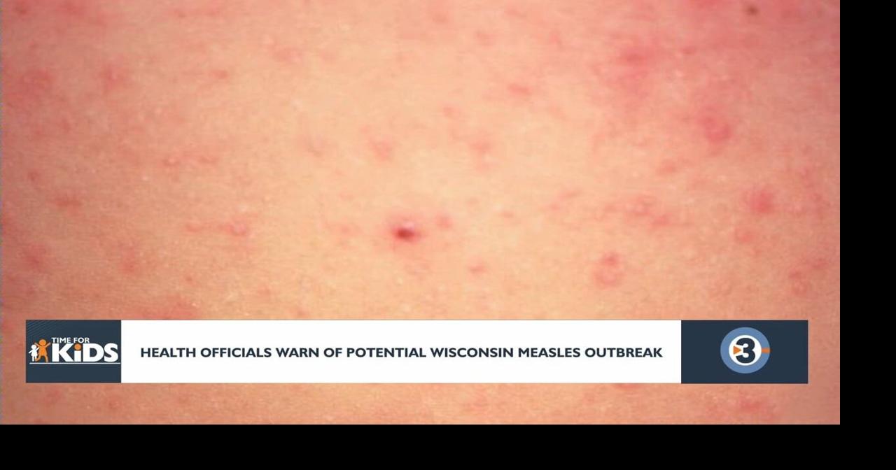 Taking a look at measles vaccination rates in Wisconsin in light of ...