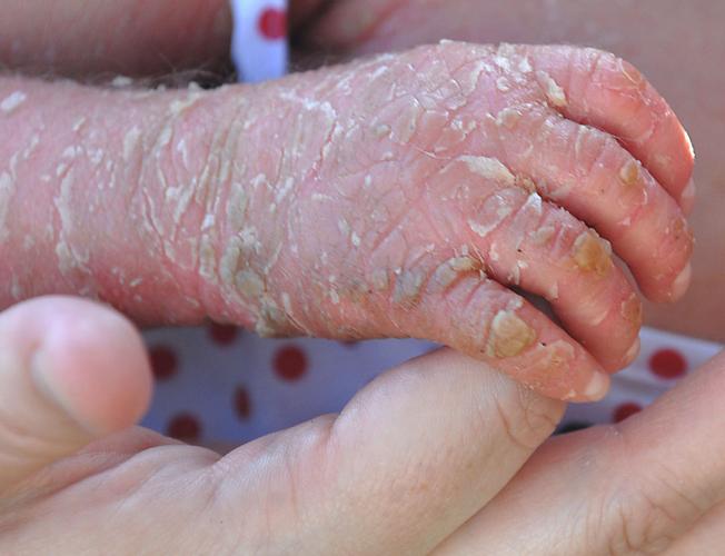 Child’s rare disorder is only skin deep | Local News | chronicleonline.com
