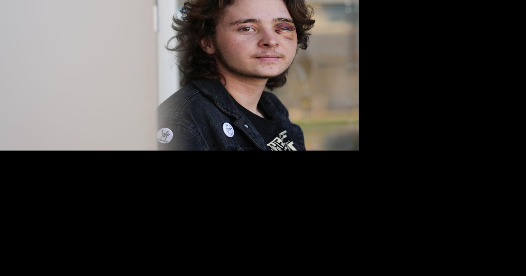 California protester left blind in one eye is among string of violent ...