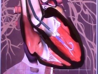 Tiny Heart Device Could Make Big Impact | | coasttv.com