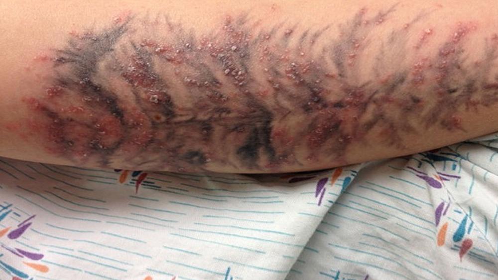 problems caused by tattoos