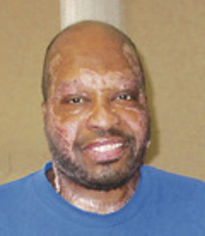 After surviving severe burns, Greg Dobson of Defiance is called a ...