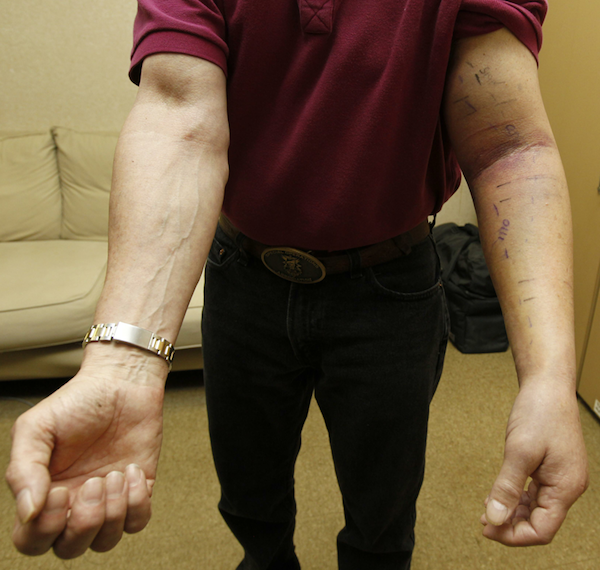 Snakebite- Encounter with a copperhead