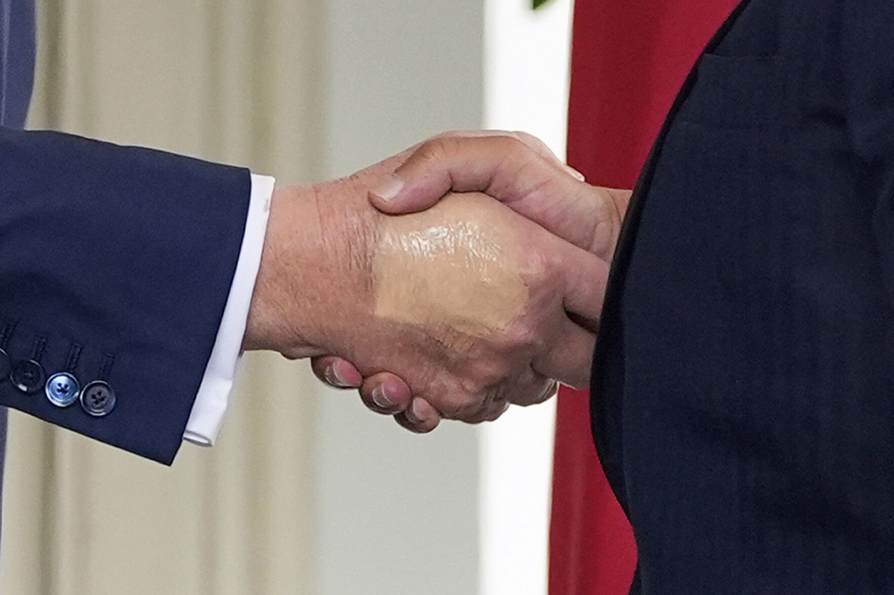 Trump checked for lower leg swelling, diagnosed with common condition ...