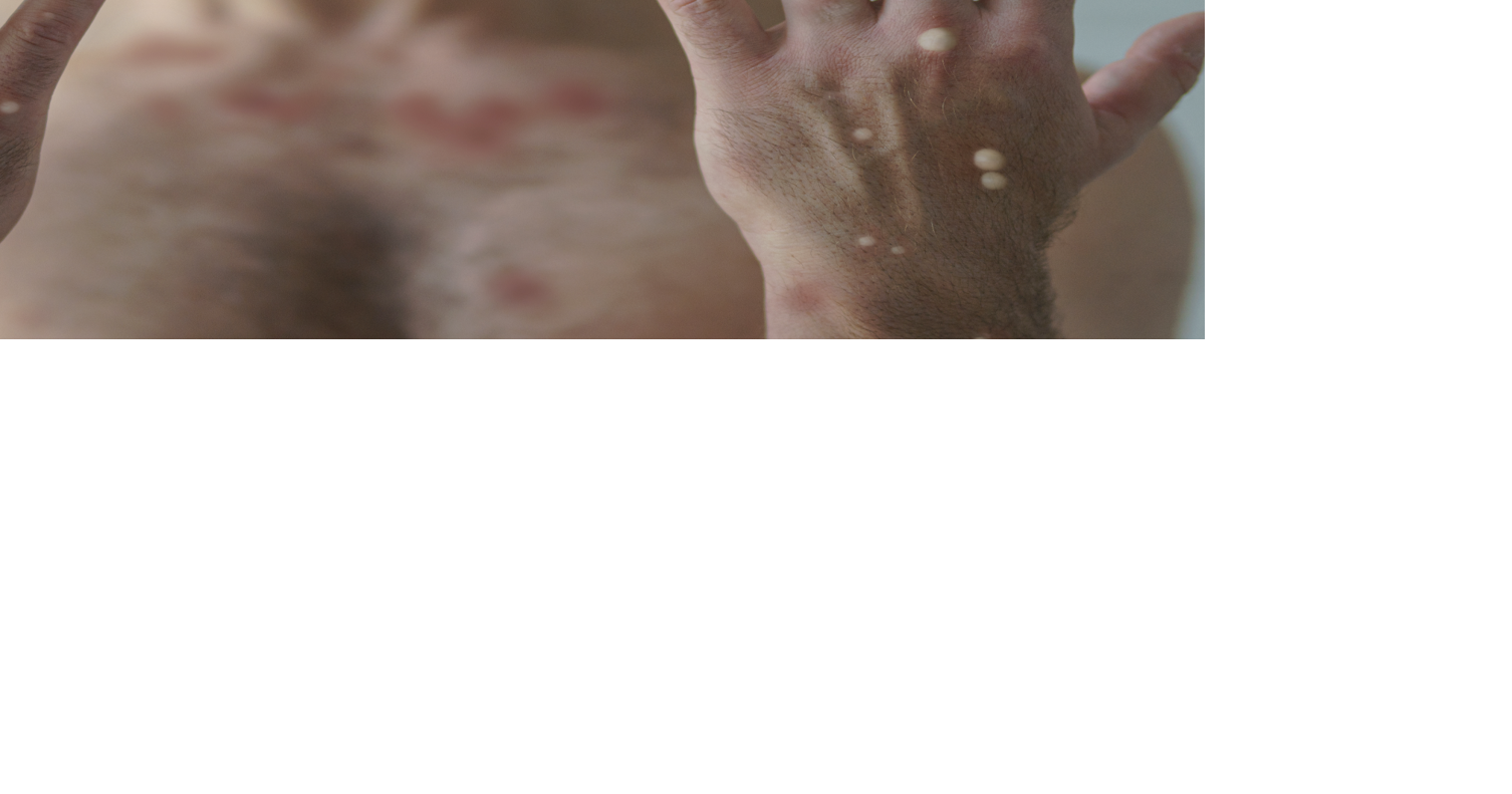 Health Department has monkeypox advice | Health & Food | fairfaxtimes.com