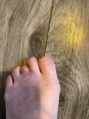 Grandma loses fingers and toes to sepsis after botched diagnosis ...