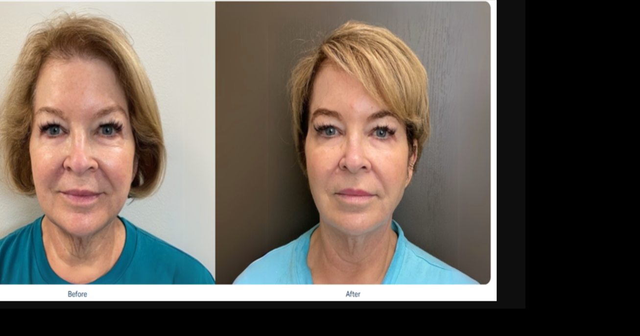 Ozempic Face Treatment: Understanding and Addressing Facial Volume Loss ...
