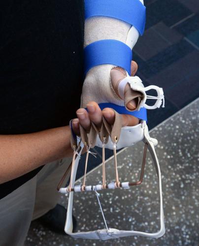 Man receives hand transplant at Duke University Hospital | Archives ...