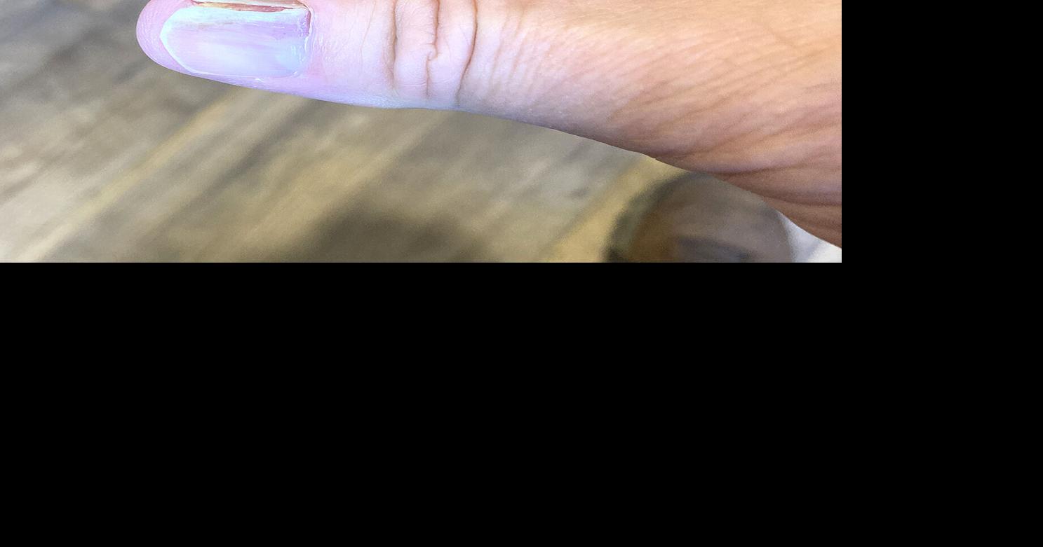 Bump on a thumb — melanoma, really? | Lifestyle | gjsentinel.com