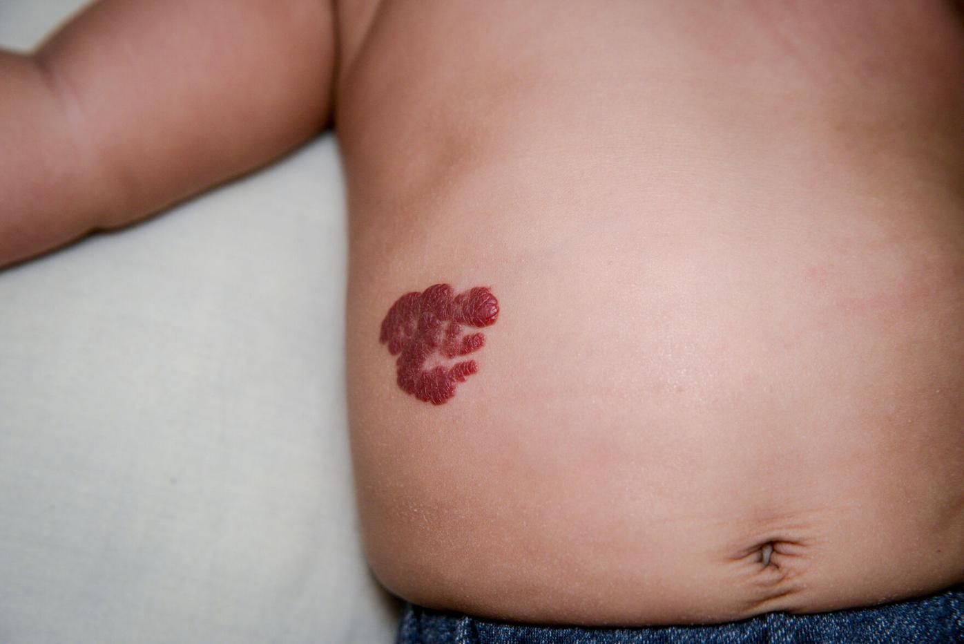 belly birthmark