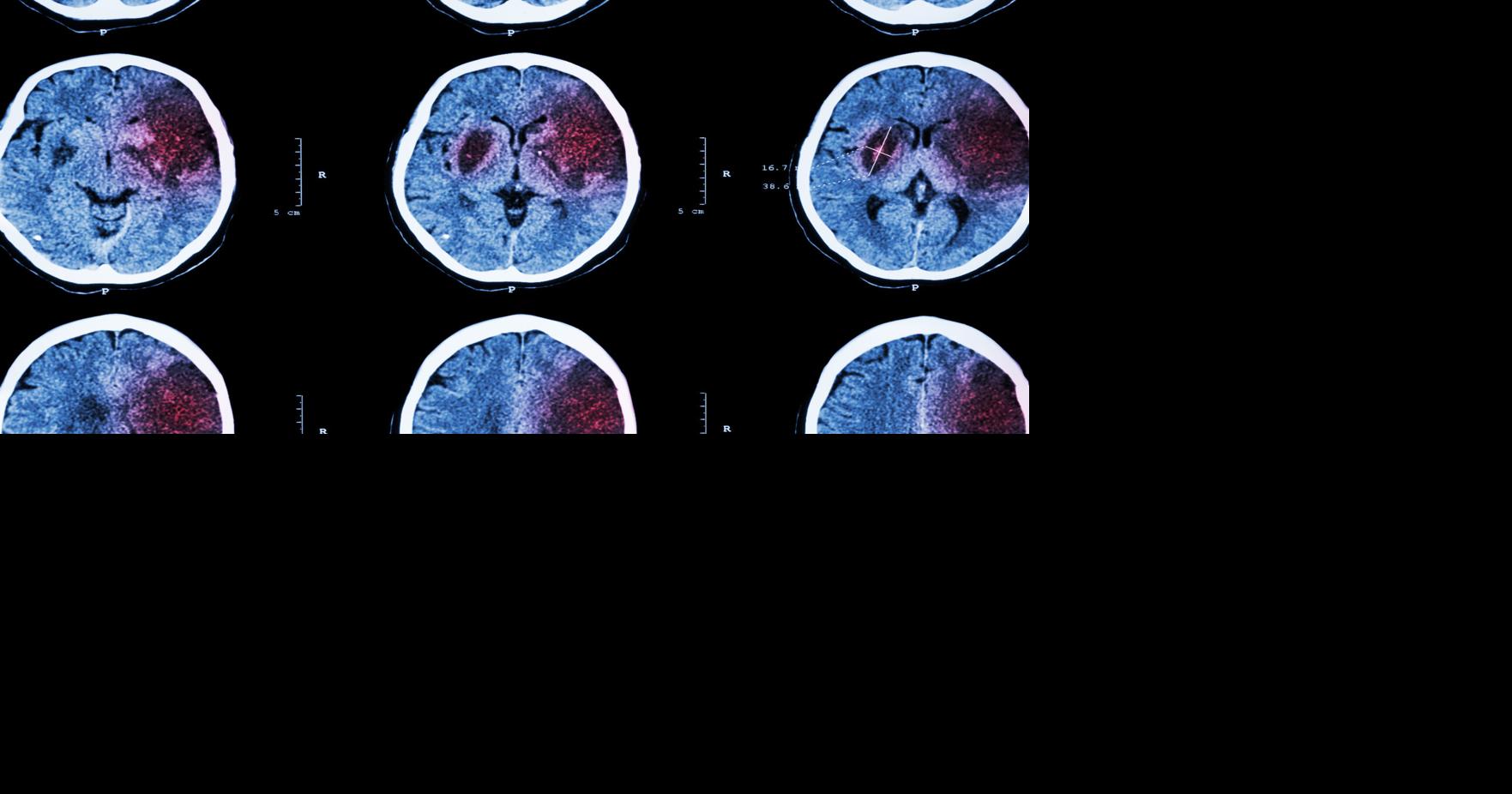 Mayo Clinic Q and A: Clot buster? Surgery? What is the right treatment ...