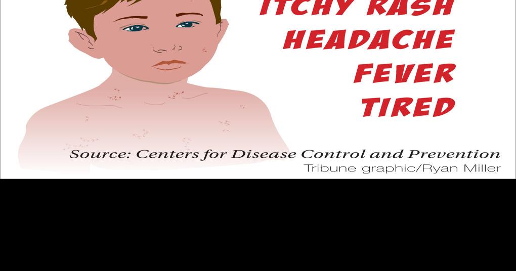 Chickenpox vaccine urged in wake of outbreak | Health Care ...