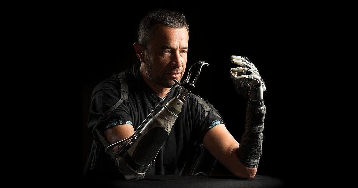 Improved Bionic Hand Has A Mind Of Its Own, Researchers Say | Wellness ...