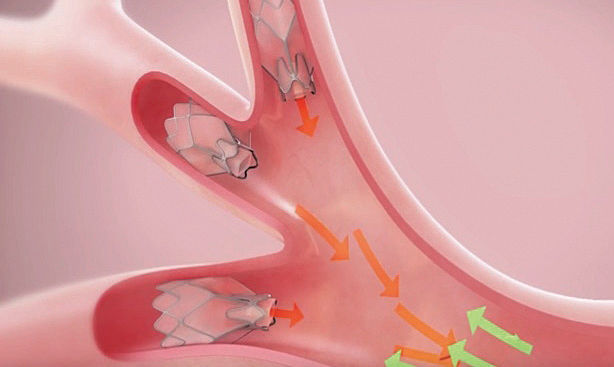 Cabell Huntington Hospital first in West Virginia to use the Zephyr ...