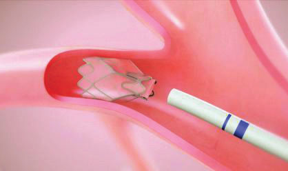 Cabell Huntington Hospital first in West Virginia to use the Zephyr ...