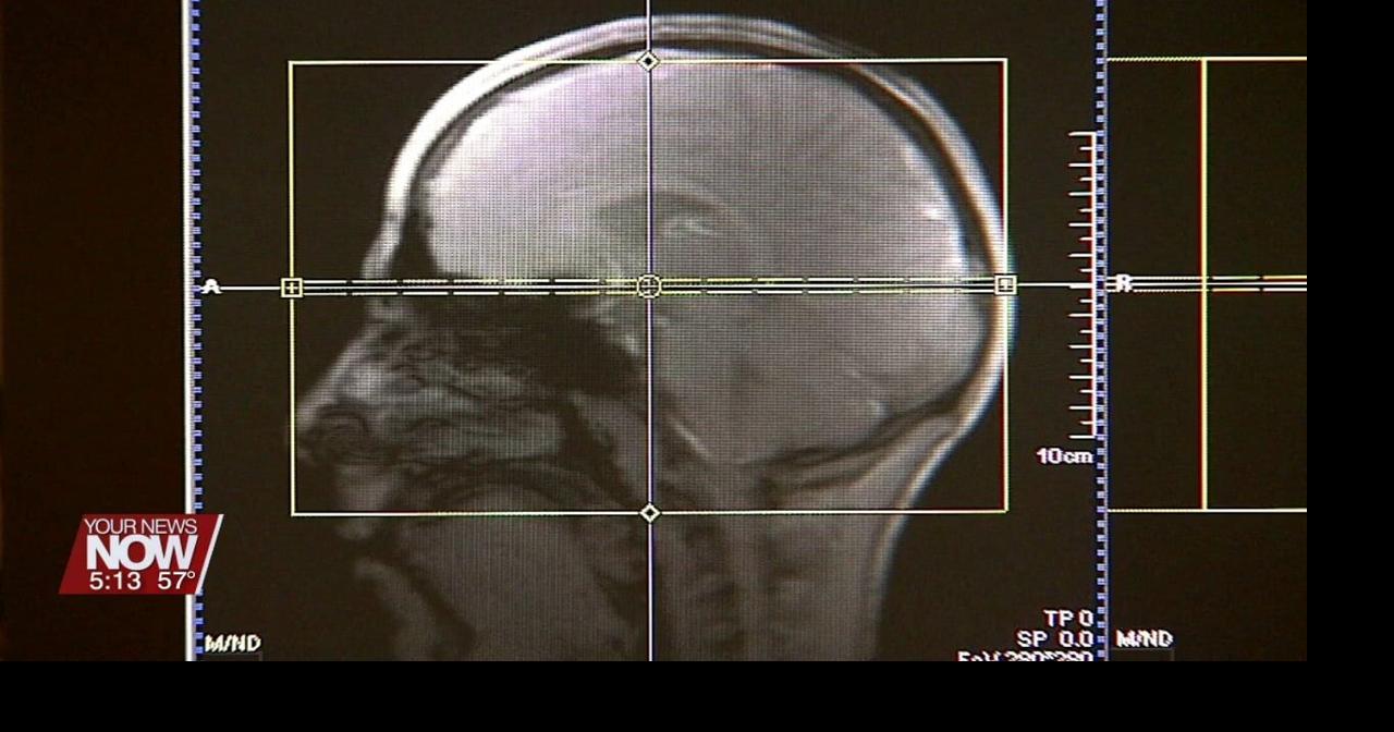 Researchers make new discovery that could help diagnose CTE brain ...