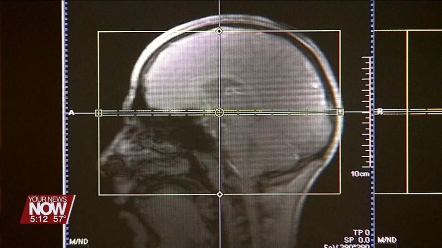 Researchers make new discovery that could help diagnose CTE brain ...