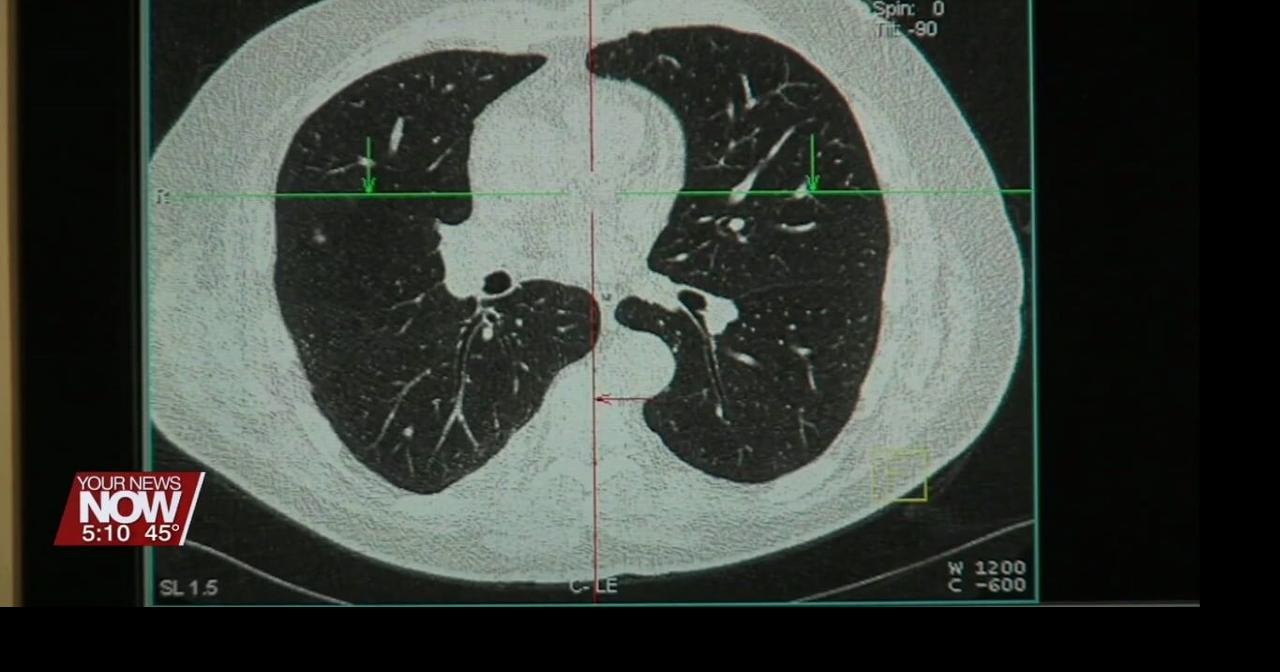 Lung Cancer More Common in Women, Study Finds | News | hometownstations.com