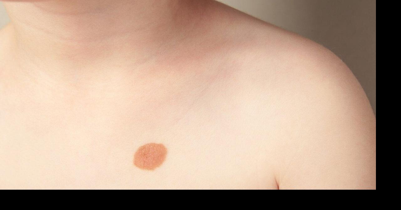 Moles vs. birthmarks: What's normal and what warrants a check | Health ...