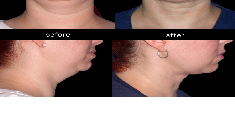 Several non- or low-invasive procedures available to fix double chin ...