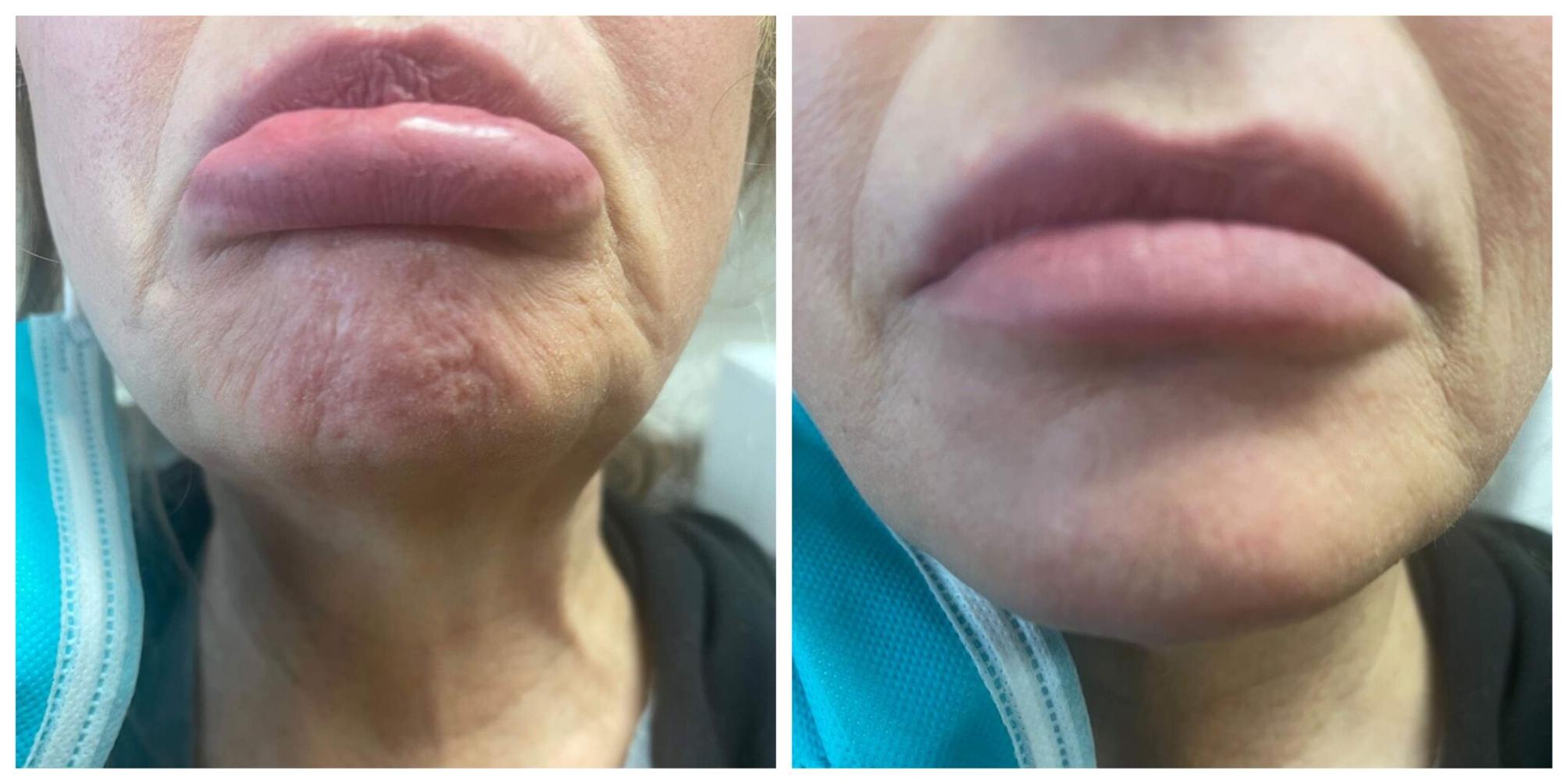 Botox can help improve the look of a dimpled chin | Health ...