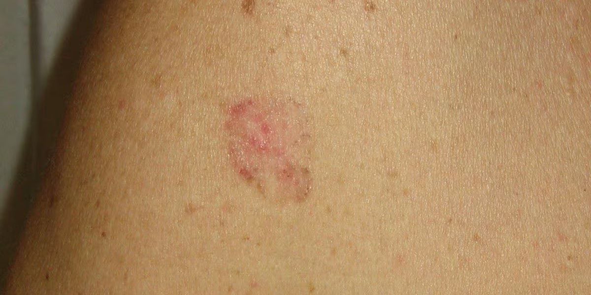 Cáncer de piel: señales clave para detectarlo a tiempo | Noticia ...