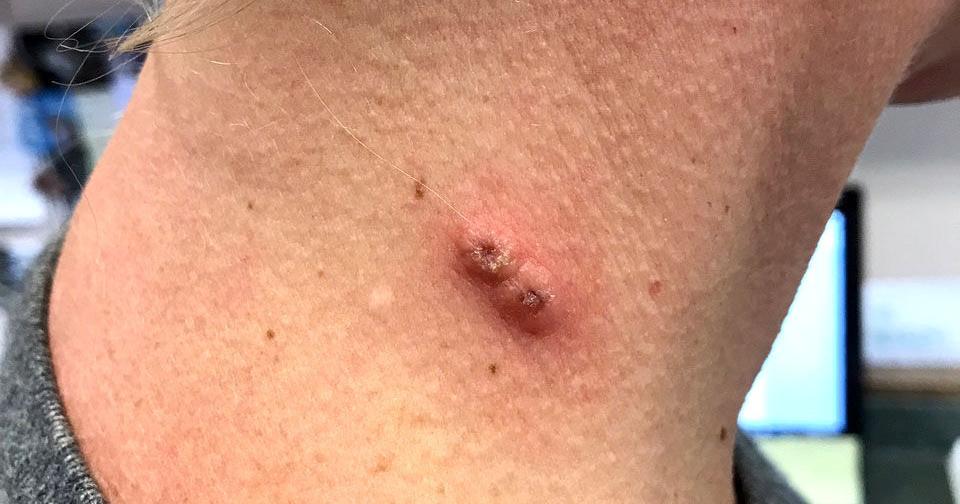 brown bat bite marks