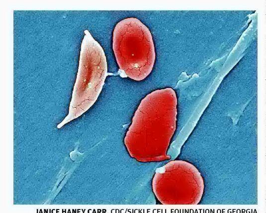 Sickle cell therapy approved in Britain