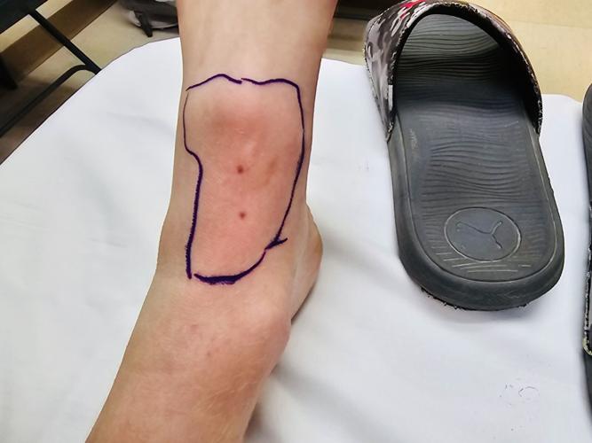 worst snake bite ever