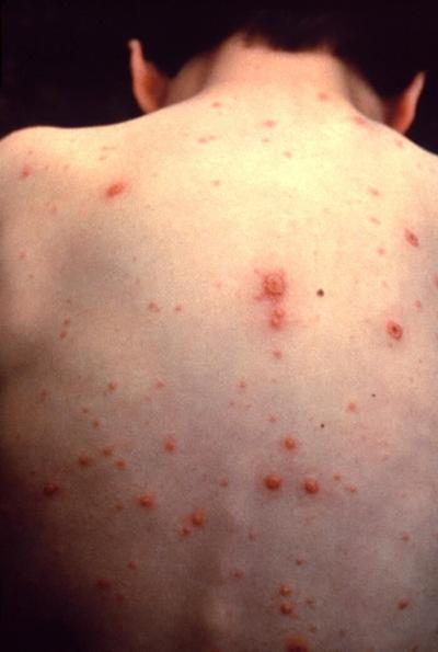 Varicella vaccine can prevent chicken pox | News | kentuckytoday.com
