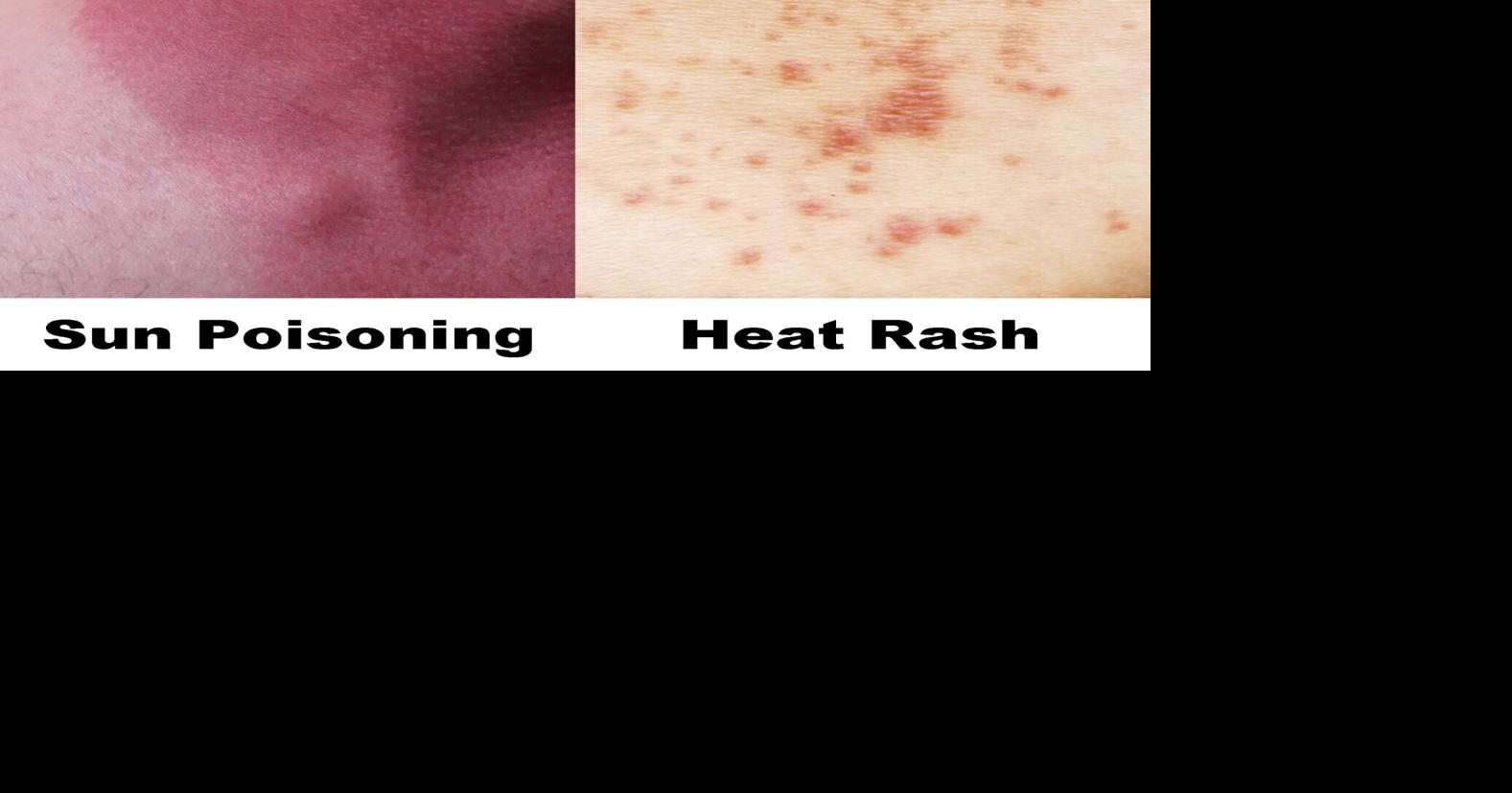 Summer hazards: From heat rash to heat stroke | Columns | keysnews.com